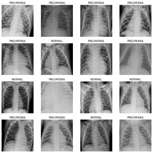 Pneumonia คืออะไร พัฒนาระบบ AI ช่วยวินิจฉัยโรค Pneumonia จากฟิล์ม X-Ray ...